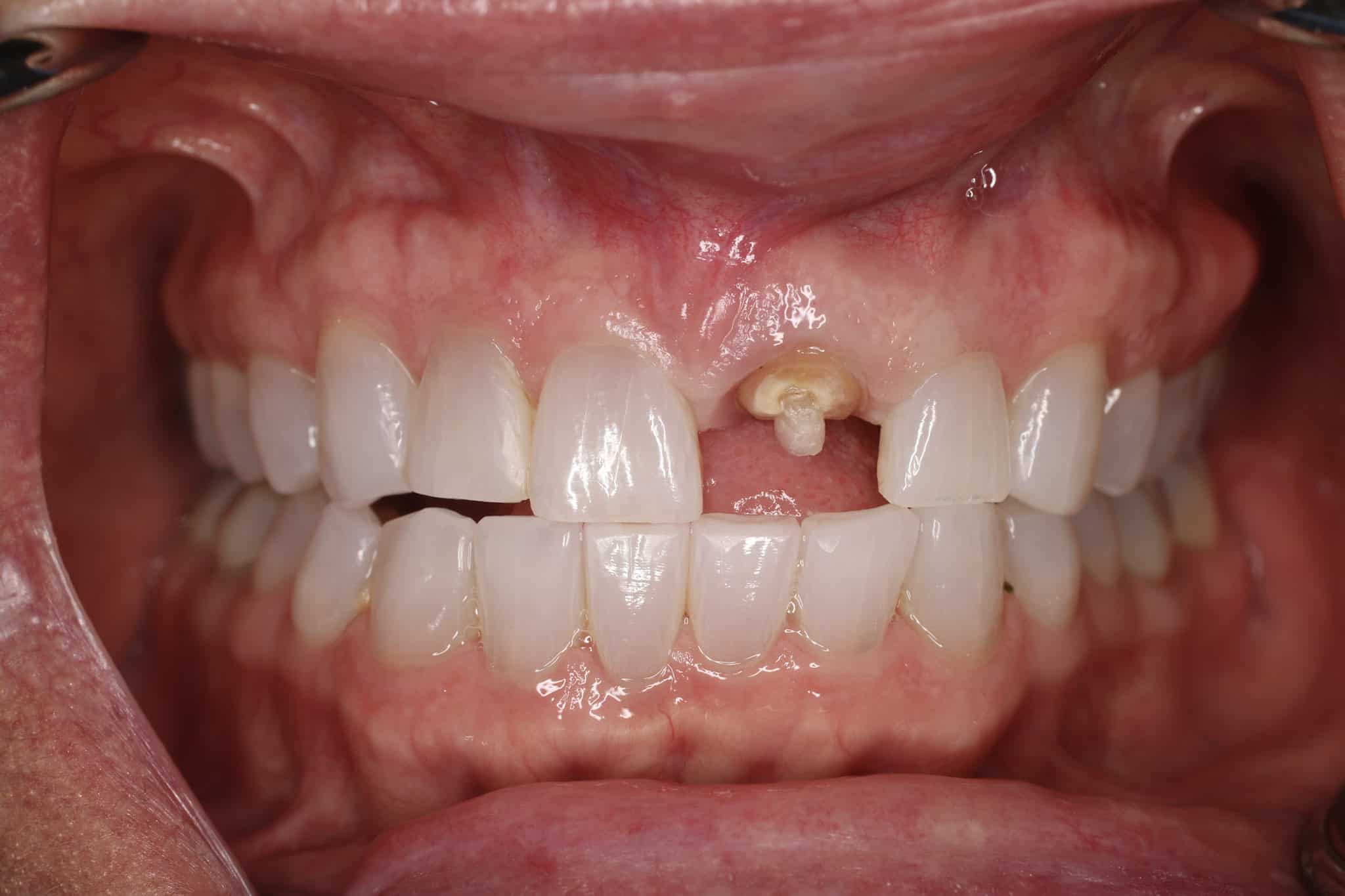 Dental Implant Case Study: Transforming a Fractured Tooth into a ...
